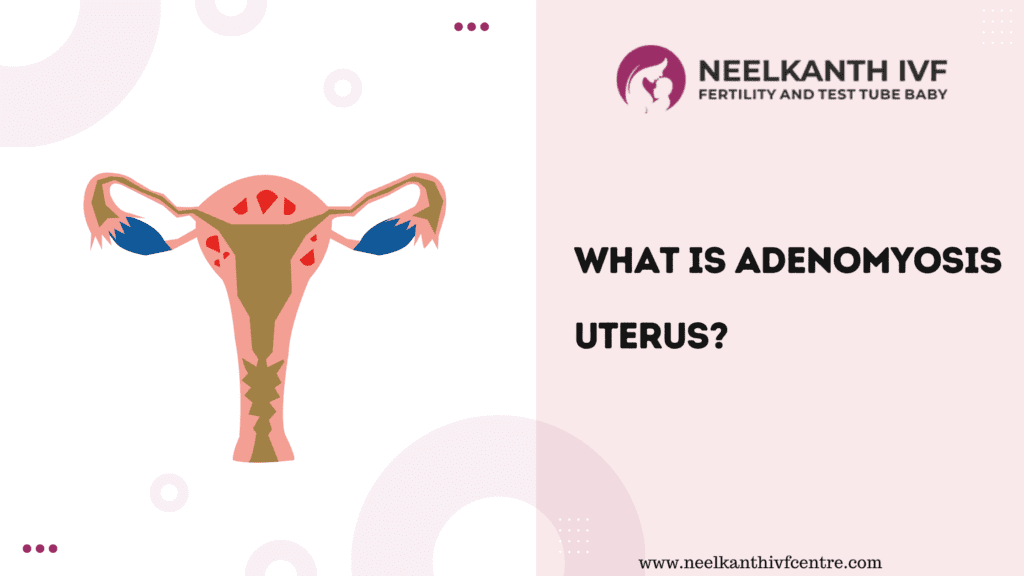 What Is Adenomyosis Uterus - Neelkanth IVF