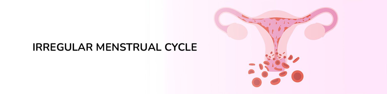 Irregular Menstrual Cycle - Neelkanth IVF Centre