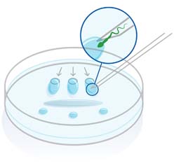 PICSI (Physiological ICSI) - Neelkanth IVF Centre